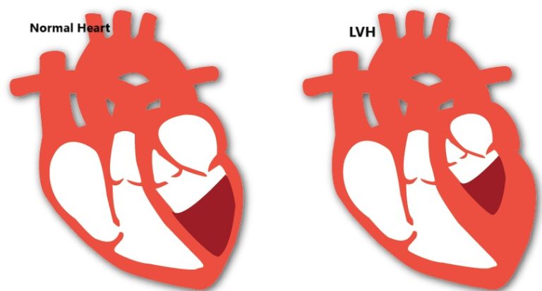 Left Ventricular Hypertrophy - medlight2u.com